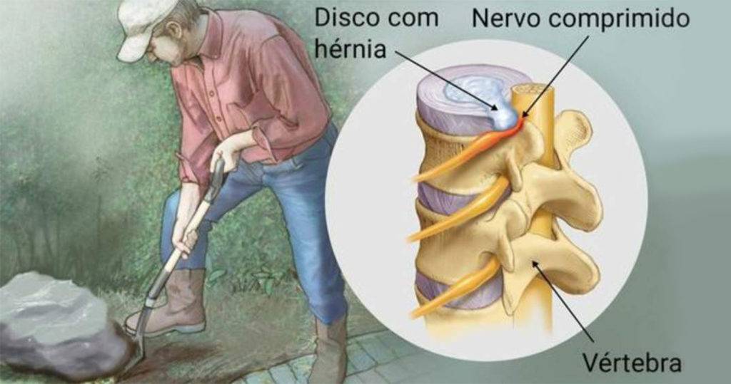 Coluna travada - O que fazer na hora do desespero? - Be Your Future